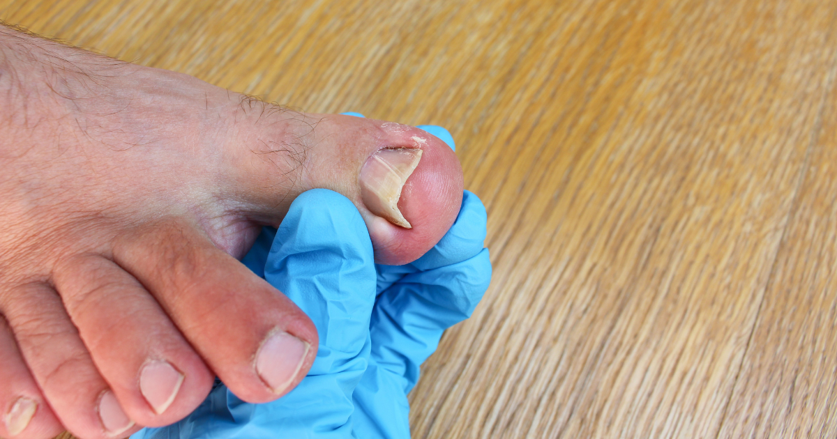 Uñas encarnadas y la cirugía como solución definitiva - Alejandro ...